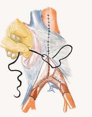 aaa-drawing – SURREY&LONDON Veins, Arteries & Hernias Clinic